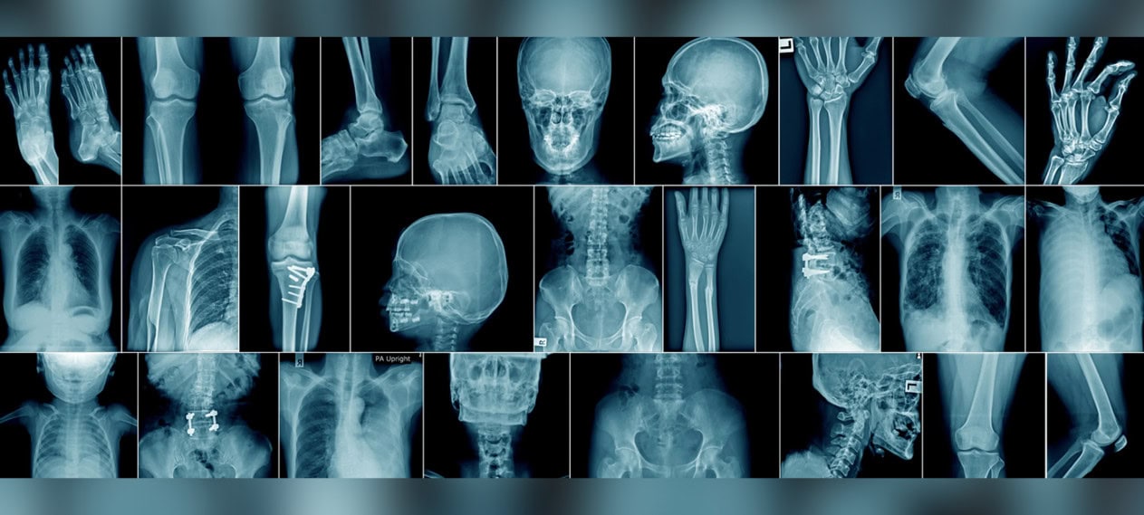 AI To Support Doctors In Detecting X-ray Fractures - News Guru